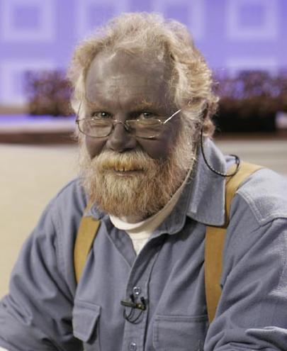 Raras enfermedades: octubre 2015